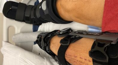 Lessons I learned over the summer when I had no leg to stand on ...